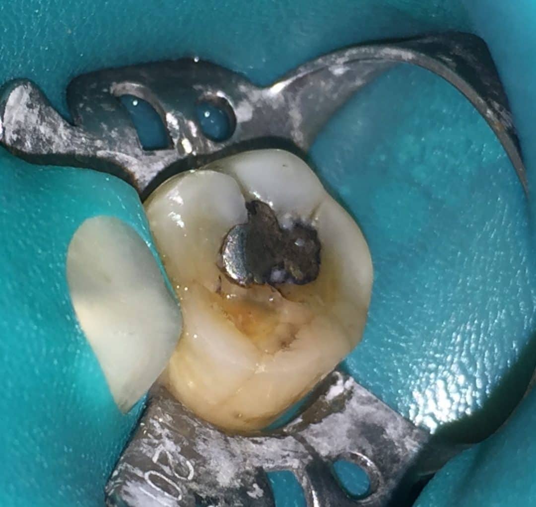 Safe Amalgam Filling Removal in Maryland Holistic Care