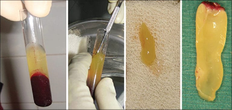 Holistic Tooth Removal with Dental PRF and Ozone