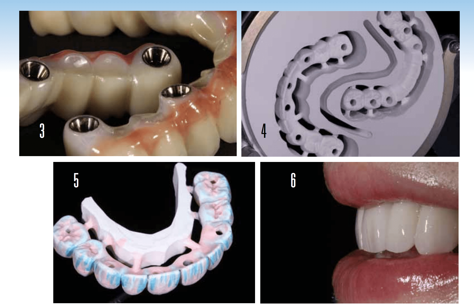 Zirconia Full Mouth Dental Implant Teeth?