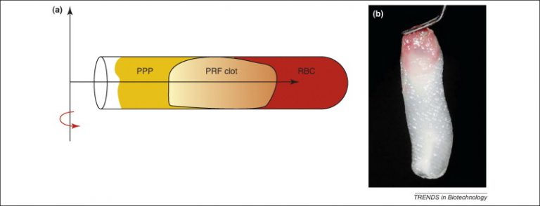 L-PRF vs I-PRF vs PRGF - How are they different?