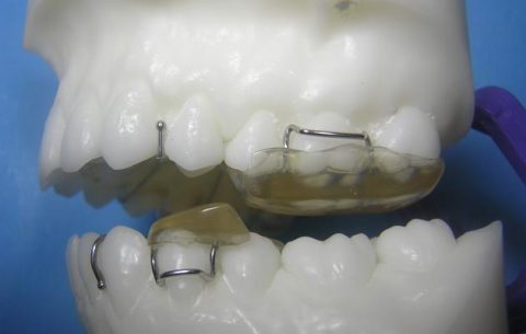 Twin Block Orthodontic Appliance | Maryland Holistic Dentist