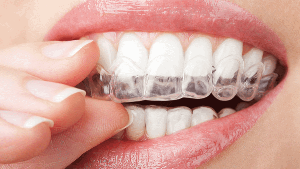 Clear aligners cost store