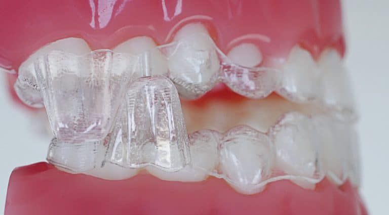 How to Move the Lower Jaw Forward with Invisalign